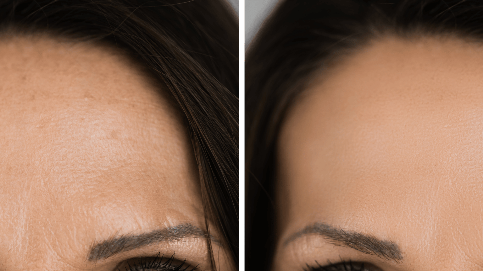 ¿Cómo funciona el efecto del botox en la piel? - Atractivia